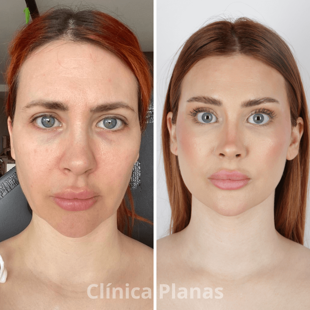 Light Lifting, cirugía antiedad para rejuvenecer el rostro - Tu blog de medicina y cirugía ...