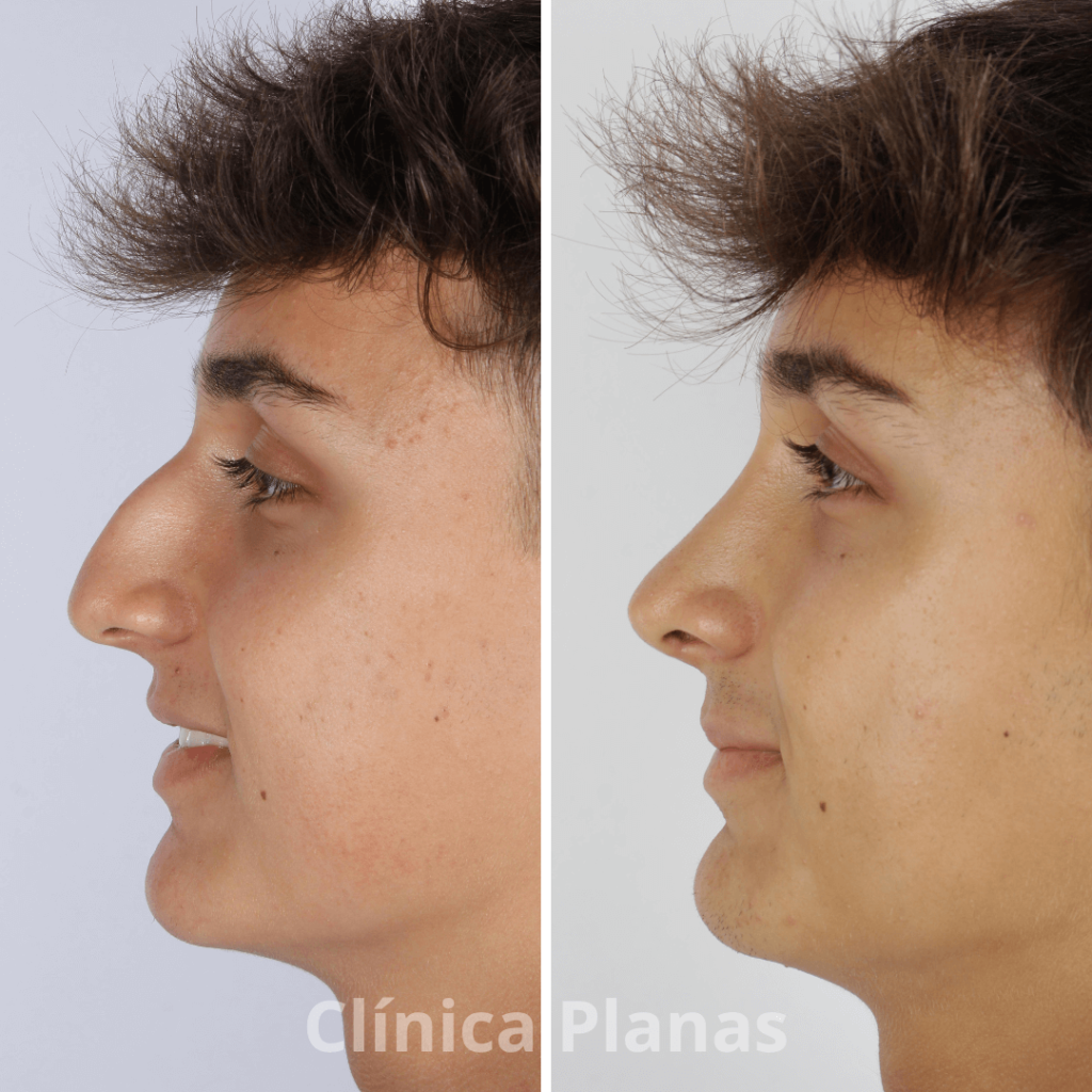 Nariz aguileña: cómo es, procedimientos y recuperación - Tu blog de medicina y cirugía estética ...