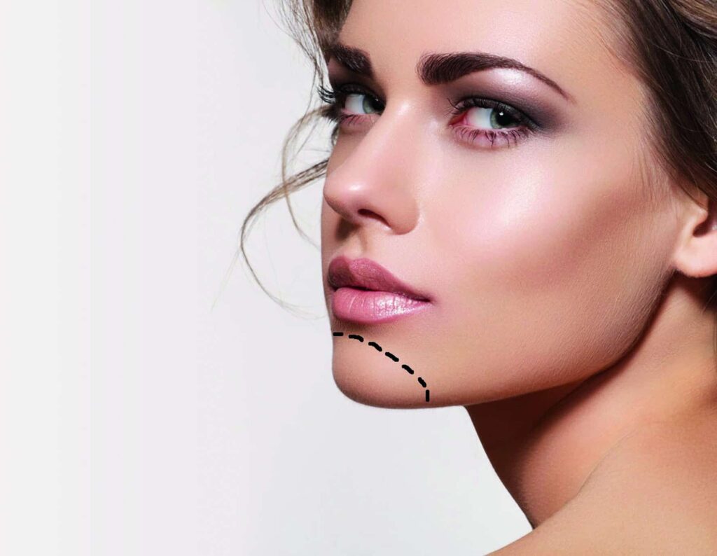¿Cómo se puede aumentar el mentón? - Dr. Jorge Planas Blog