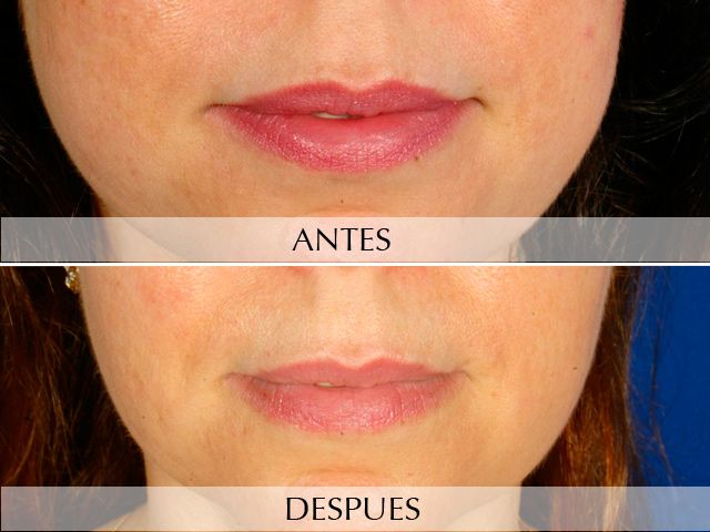 Bolas de Bichat | Clínica Planas Barcelona Madrid