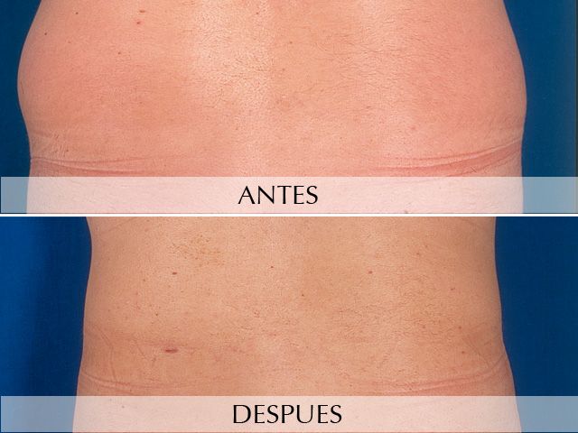 Liposucción | Clínica Planas Barcelona Madrid