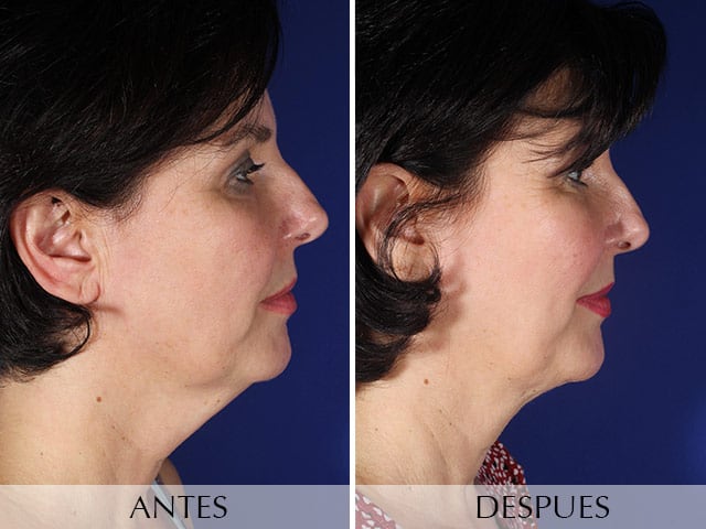 Cirugía de Mentón | Mentoplastia | Clínica Planas Barcelona Madrid